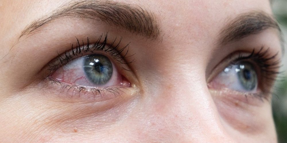 What Is Dry Eye Syndrome? Definition, Symptoms, And Treatment - Health ...